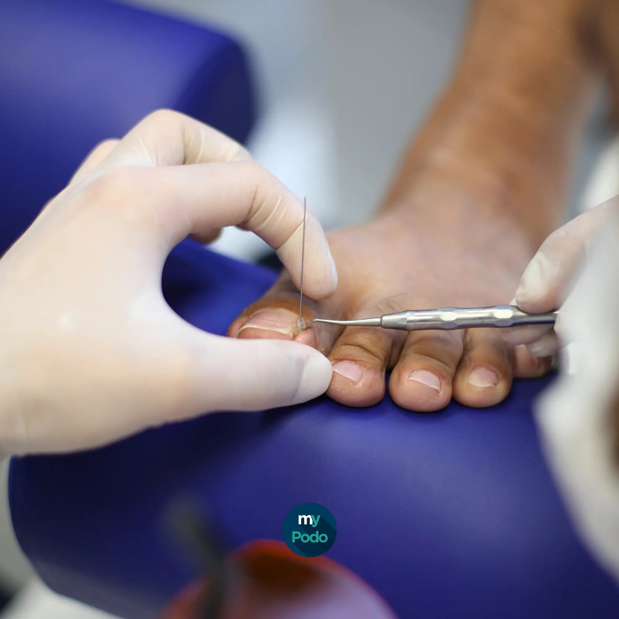 Titanium wires and resins for orthonyxia | My Podologie